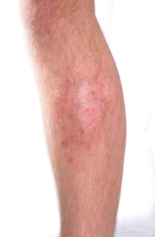 Skin Infection stock image. Image of closeup, plaque - 29559477
