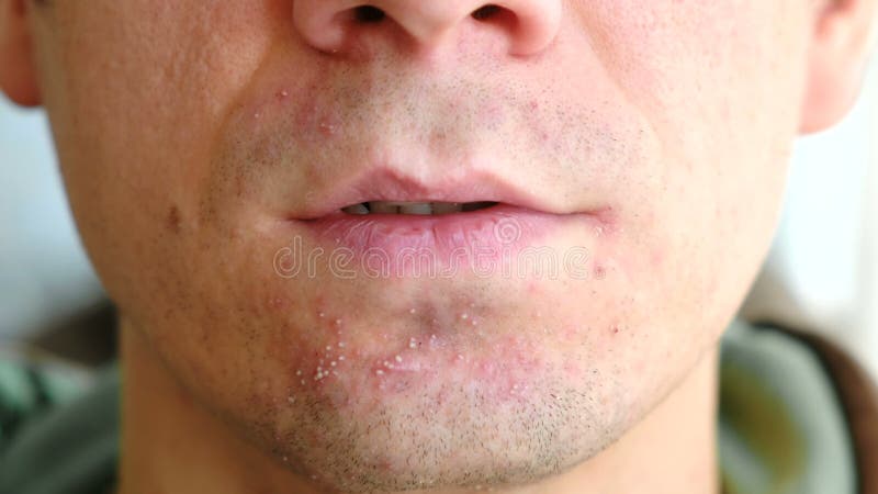 Rash On The Skin Of A Man In The Groin Area The Concept Of Venereal Diseases Stock Video