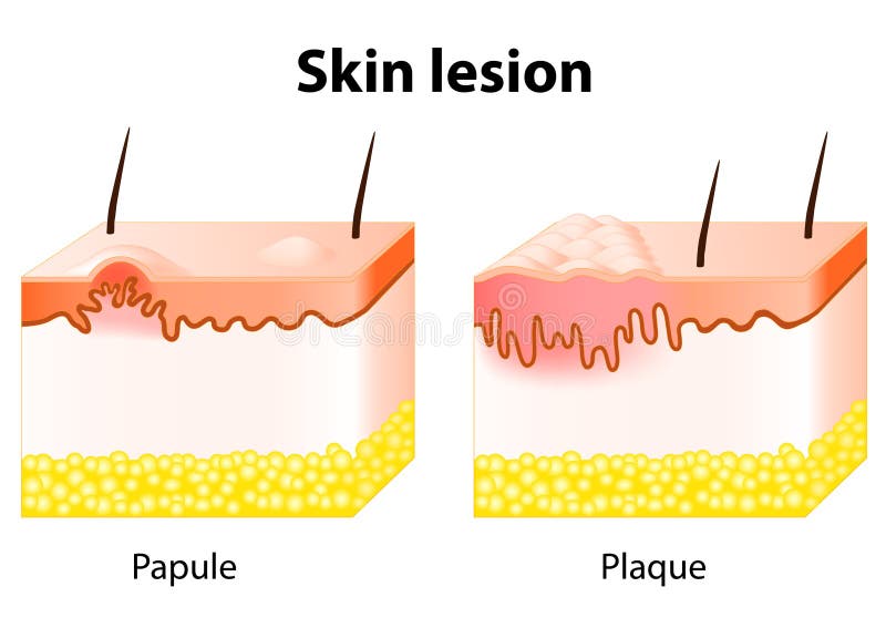 Skin lesion stock vector. Illustration of illness, healthcare - 64684704
