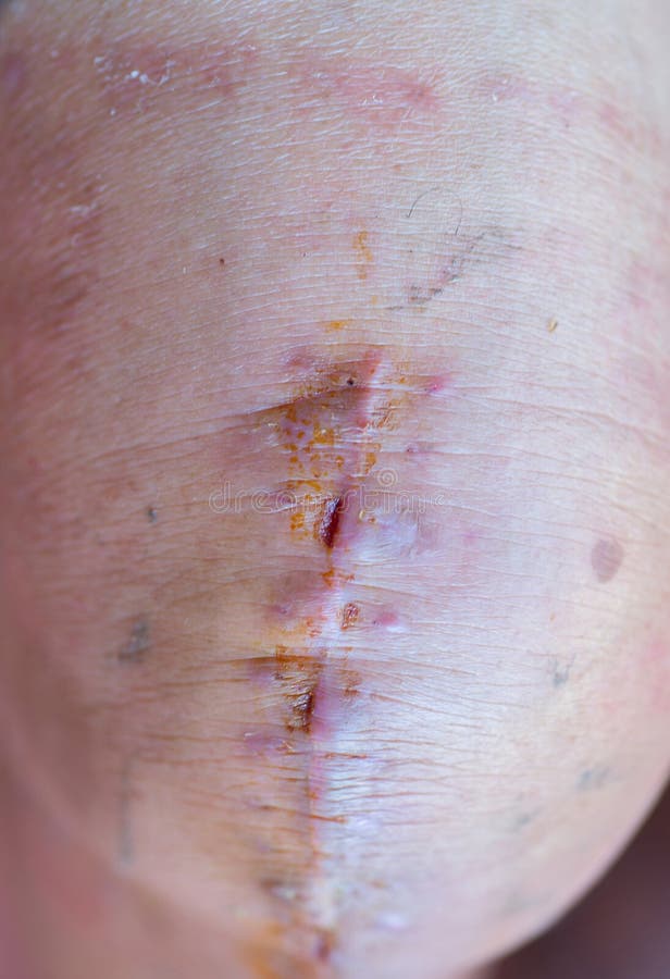 Skin lesions after surgery stock photo. Image of atrophy - 328702764