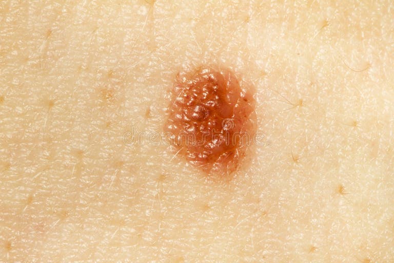 Skin Mole Macro stock photo. Image of derma, health, medical - 23921950