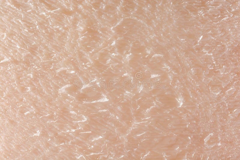 Skin Peeling on Problem Areas Stock Image - Image of disease, texture ...