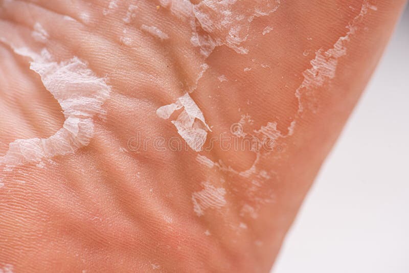 Skin Peeling on the Sole of a Foot Stock Photo - Image of healthy, peel ...