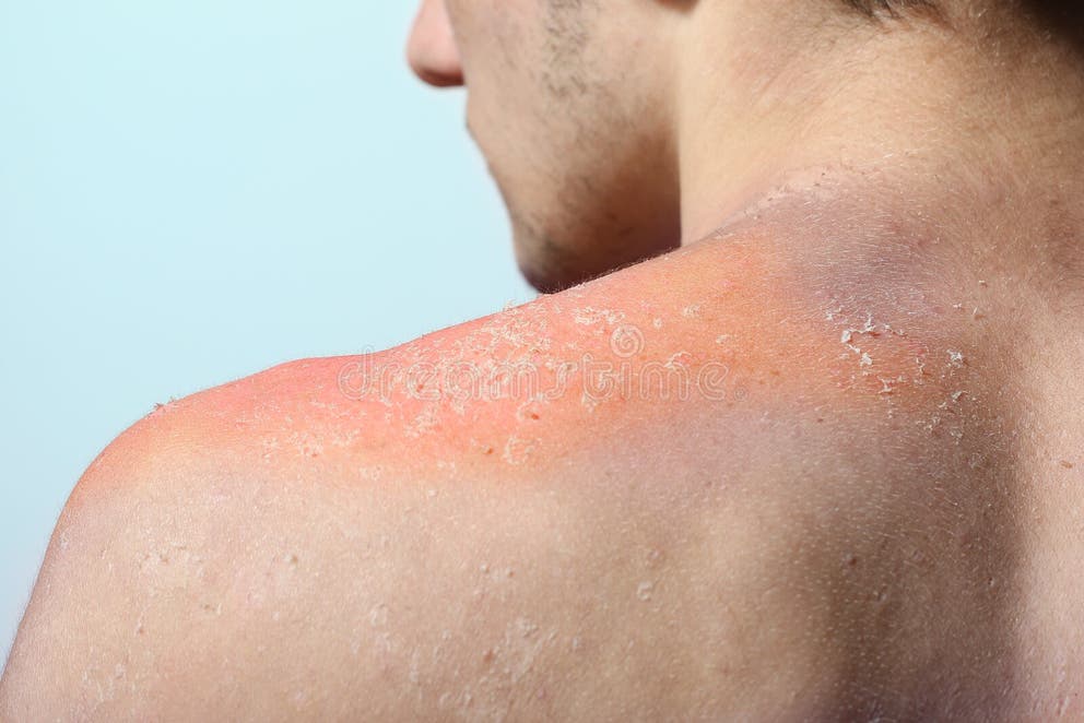 Skin peeling after sunburn stock photo. Image of epidermis - 96306500