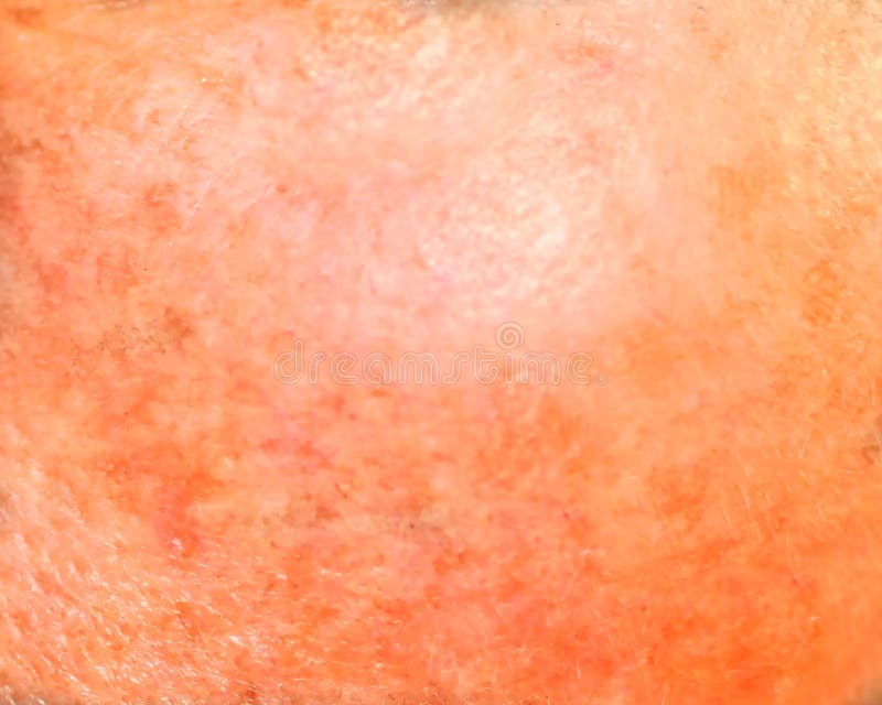 Skin Pigmentation. Brown Spots of Pigmentation on the Skin of the Face ...