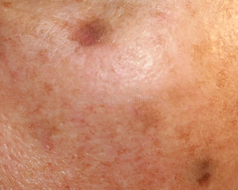 Skin Pigmentation. Brown Spots of Pigmentation on the Skin of the Face ...