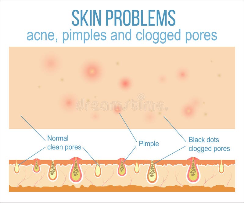 Skin and pores stock vector. Illustration of reduce, layer - 91542489 Skin and pores stock vector. Illustration of reduce, layer - 91542489