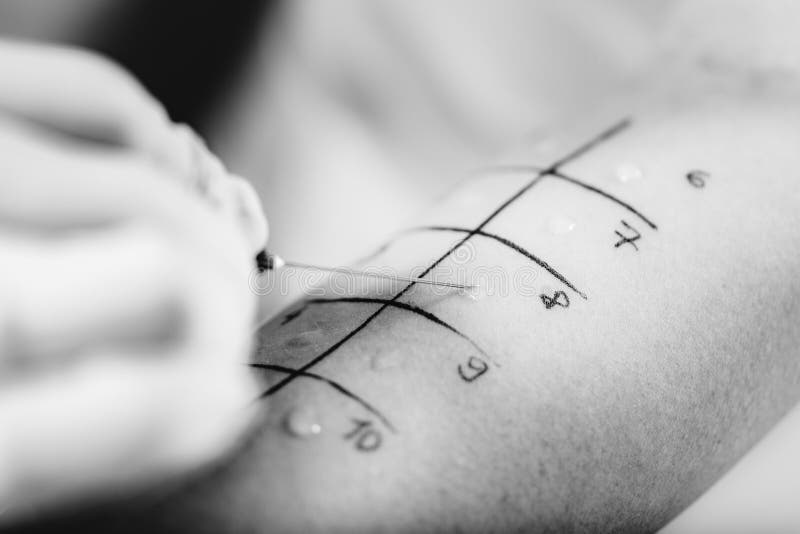Skin Allergy Testing stock image. Image of hand, pipette - 270628969