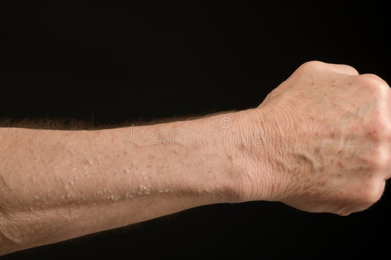 Skin Problem, Atopic Eczema Stock Photo - Image of dermatologist ...