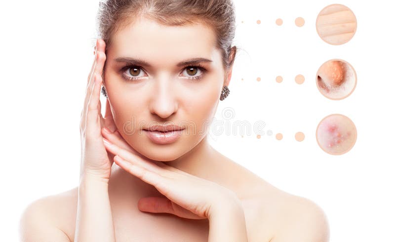 Skin problem of woman face stock photo. Image of adult - 85674132