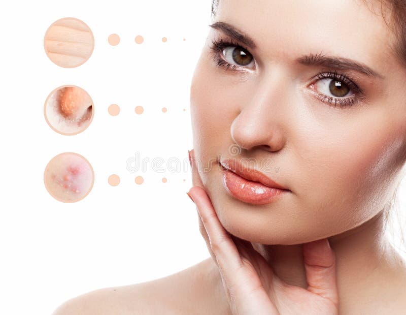 Skin problem of woman face stock photo. Image of adult - 85674132