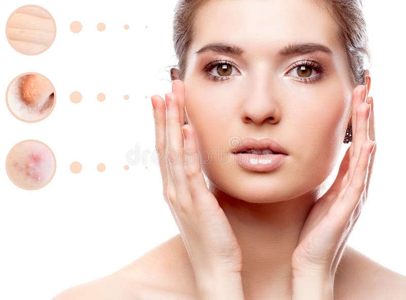 Skin problem of woman face stock image. Image of facial - 85674107