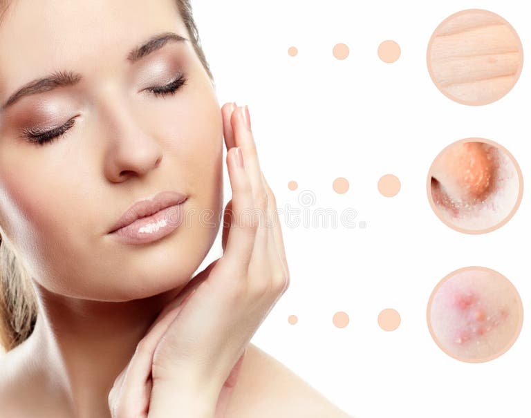 Skin problem of woman face stock photo. Image of adult - 85674132