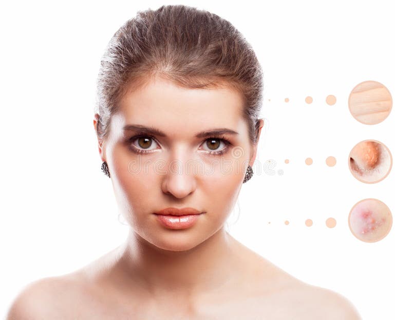 Skin problem of woman face stock photo. Image of complexion - 85674138