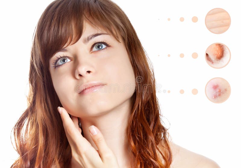 Skin problem of woman face stock image. Image of adult - 85674809