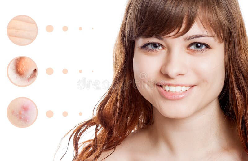 Skin problem of woman face stock photo. Image of female - 85674810