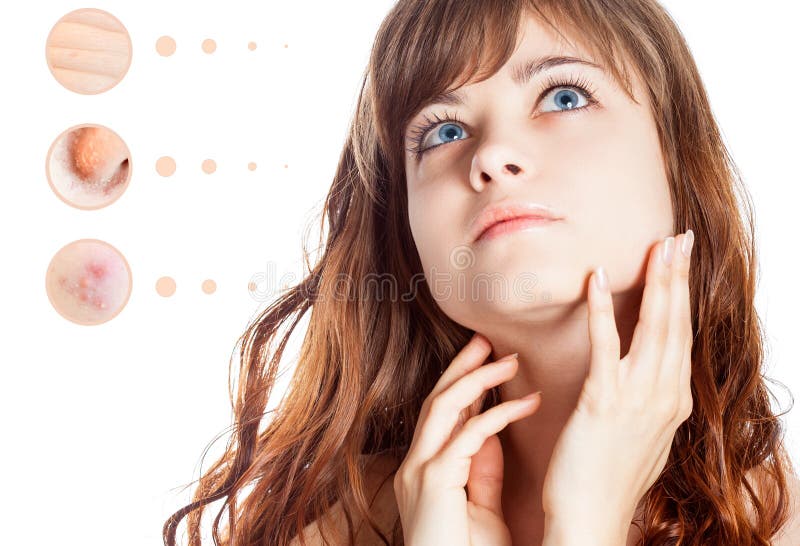 Skin problem of woman face stock photo. Image of beautiful - 85674814
