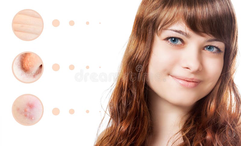 Skin problem of woman face stock photo. Image of correction - 85674848