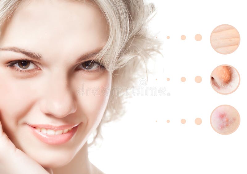 Skin problem of woman face stock photo. Image of natural - 85675190