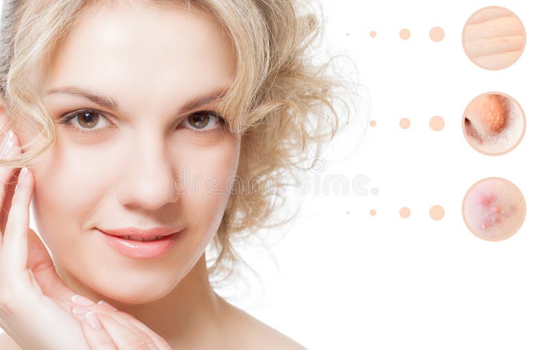 Skin problem of woman face stock image. Image of girl - 85675231