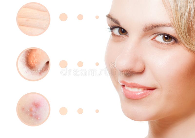 Skin problem of woman face stock image. Image of closeup - 85890333
