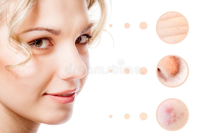 Skin problem of woman face stock photo. Image of adult - 85674132