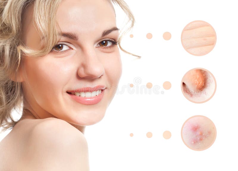 Skin problem of woman face stock photo. Image of adult - 85674132