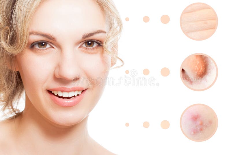 Skin problem of woman face stock image. Image of closeup - 85890333