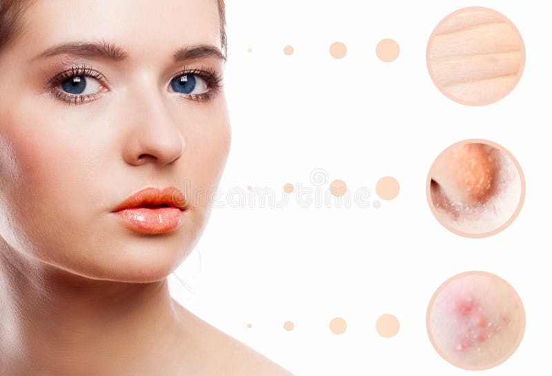 Skin problem of woman face stock photo. Image of fashion - 85890444