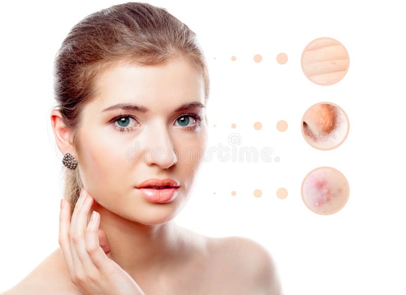 Skin problem of woman face stock photo. Image of adult - 85674132