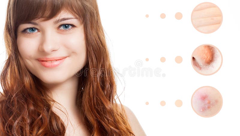 Skin problem of woman face stock image. Image of isolated - 85890513