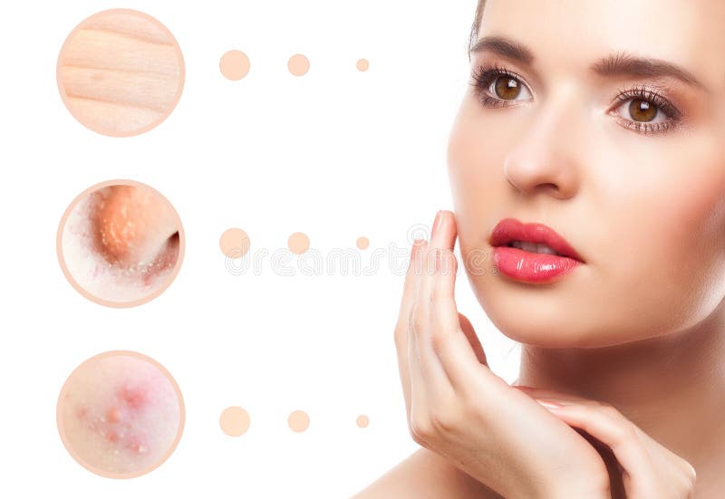Skin problem of woman face stock photo. Image of adult - 85674132