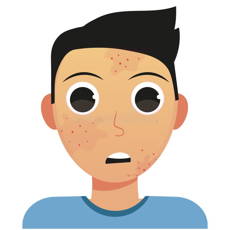 Young Man Face Problem Skin Acne Stock Vector - Illustration of clear ...