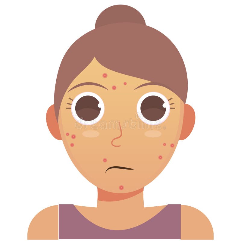 Woman With Rosacea Skin Problem. Vector Illustration Stock Vector ...