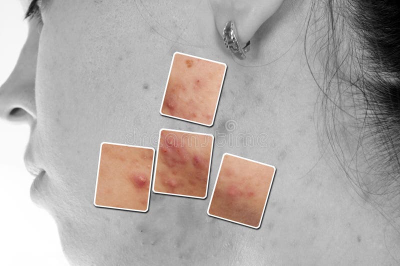 Skin problems stock photo. Image of pimple, beautiful - 28350002