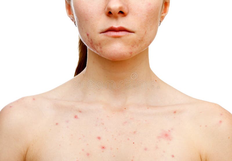 Skin problems stock photo. Image of complexion, problem - 28627550