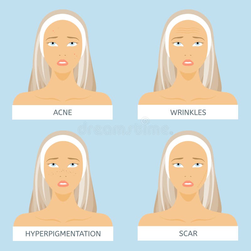 Hyperpigmentation Stock Illustrations – 893 Hyperpigmentation Stock ...