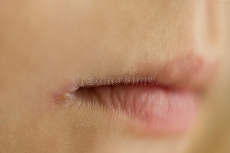 Skin Problems, Angulitis, Angular Stomatitis, Angular Cheilitis a ...