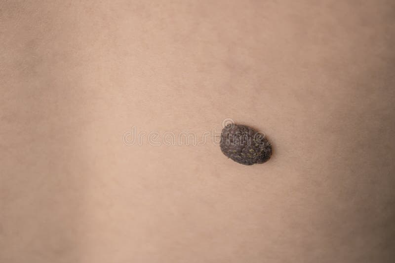 Skin Problems Closeup. Big Scary Mole on the Female Back Stock Image ...