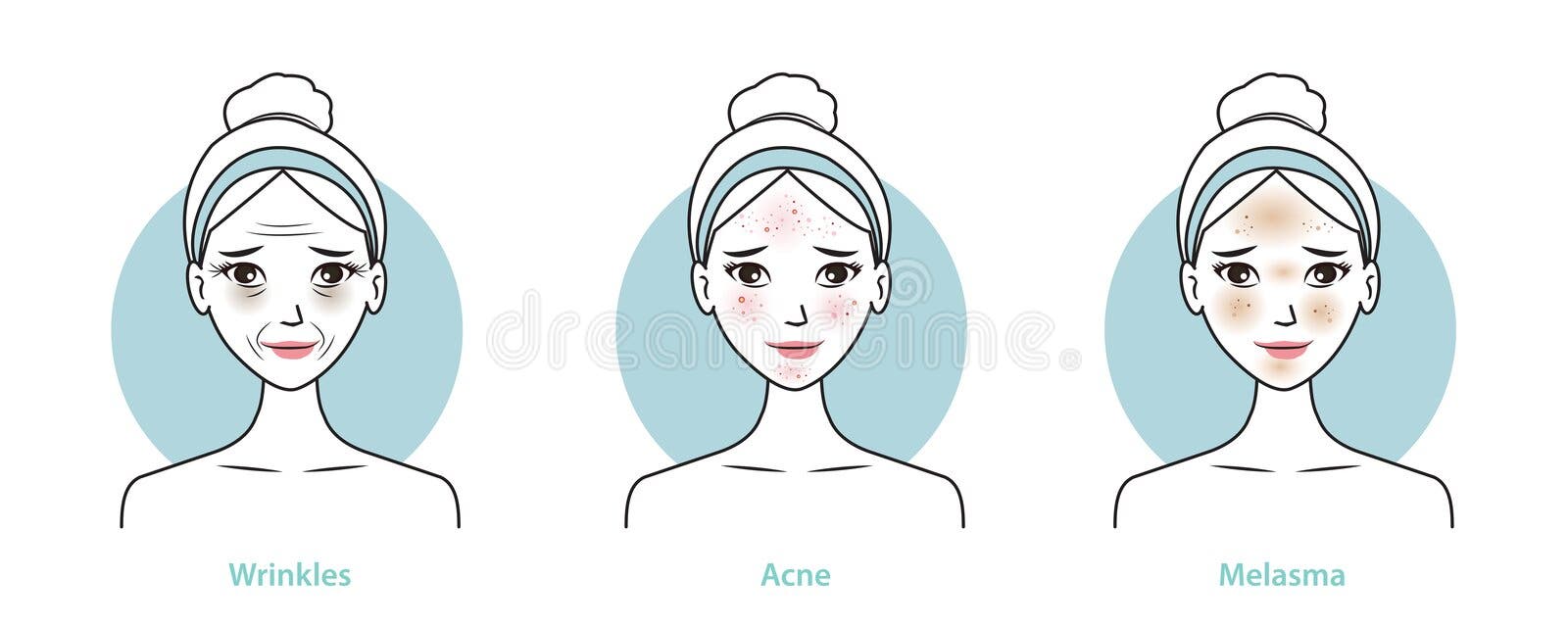 Melasma On Stock Illustrations – 68 Melasma On Stock Illustrations ...