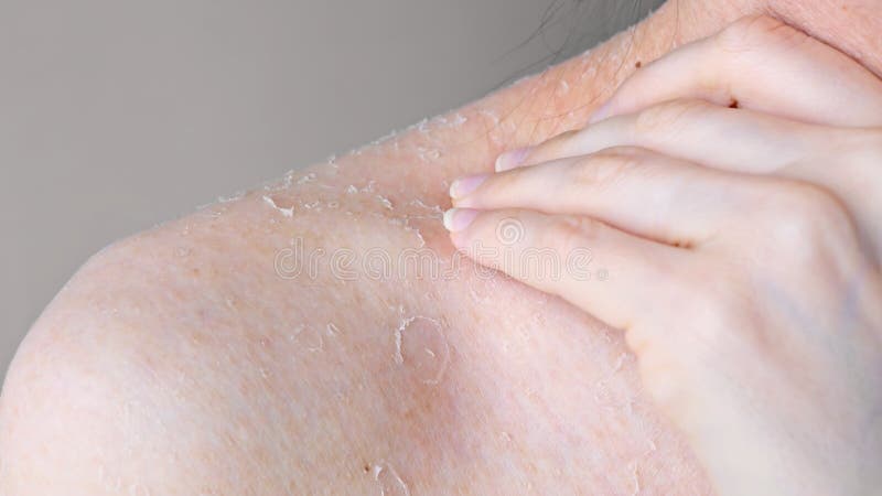 Skin Problems on Shoulder Close-up Effect of Dehydration on Problem ...