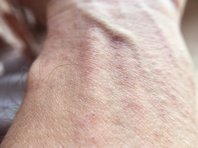 Skin rash on man hand stock image. Image of immune, rash - 145977623