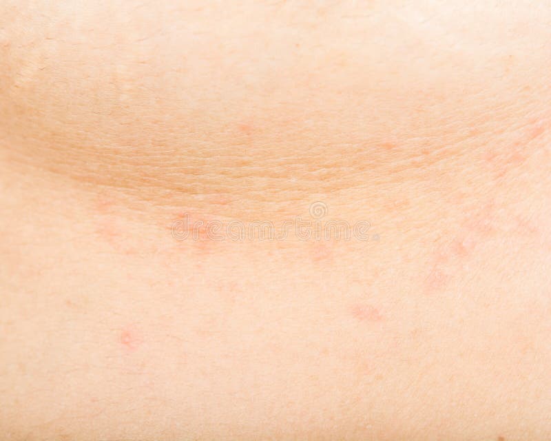 Skin Rashes and Inflammation. Stock Image - Image of healthy, rashes ...