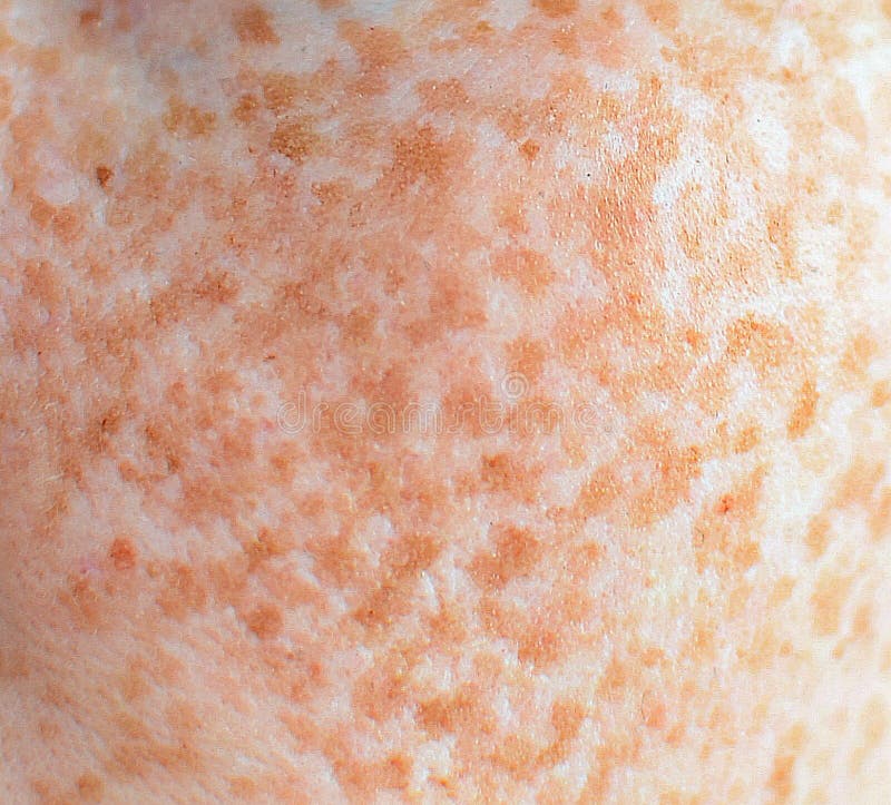 Skin with Red Freckles, Close-up, Macro Stock Image - Image of fragment ...