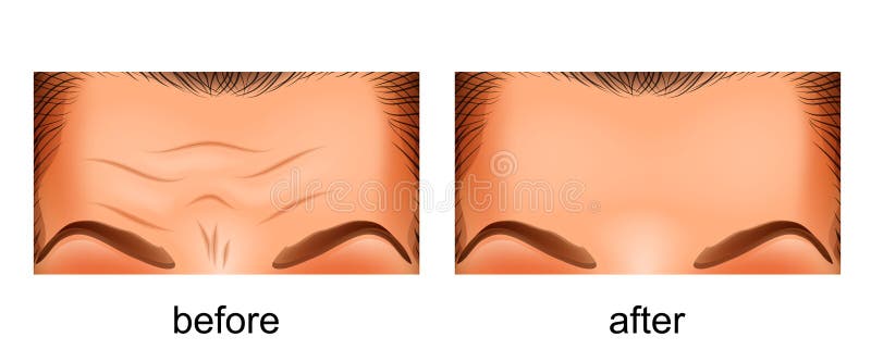 Skin Rejuvenation Forehead. before and after Stock Vector ...