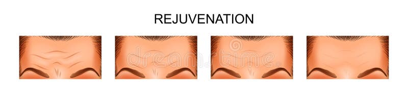 Skin rejuvenation forehead stock vector. Illustration of face - 100966182