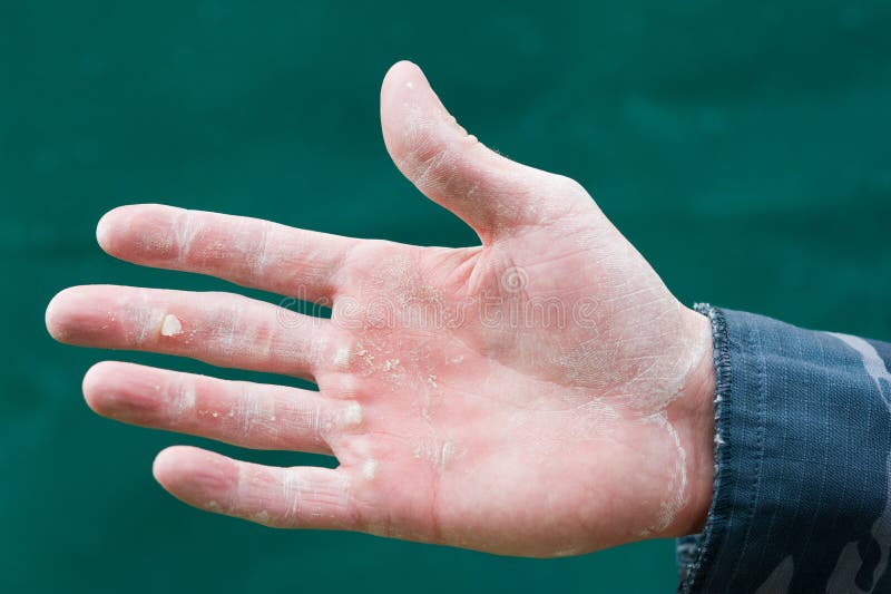 Skin rips on a hand. stock photo. Image of worker, manly - 31280000