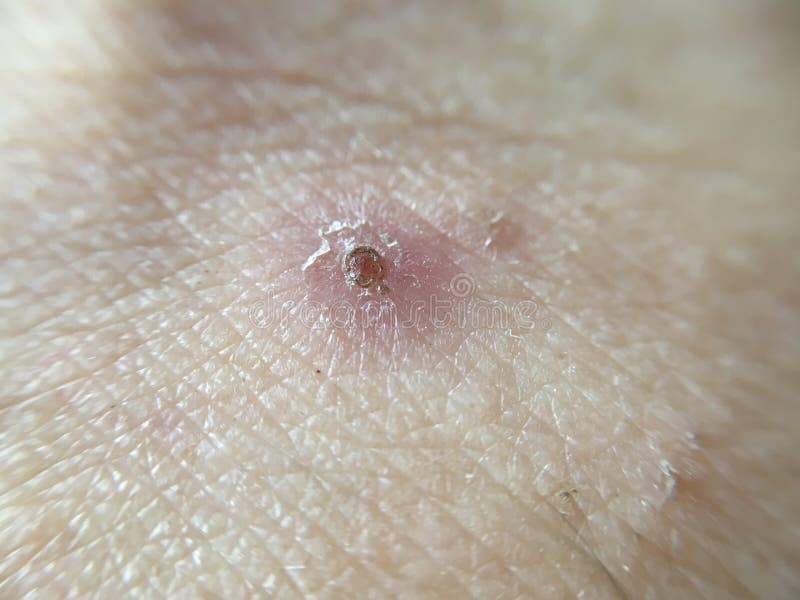 Scar on Skin. the Wound Form Scabs on Leg. Man with Long Scab Wound on ...