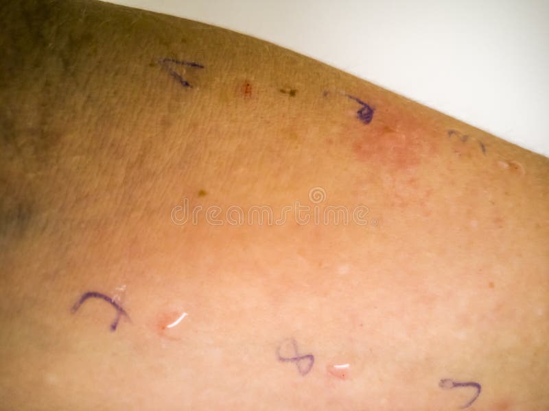 Skin Test Positive Results Closeup on Arm Stock Image - Image of ...