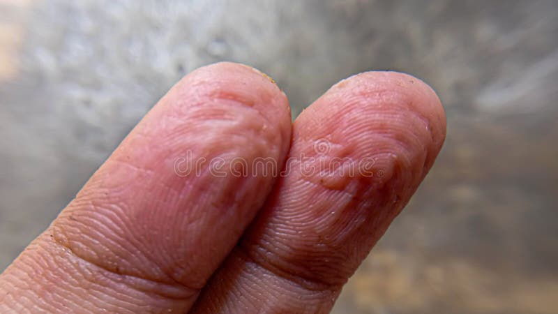 The Skin of Two Wrinkled Fingers Stock Photo - Image of wrinkles, thumb ...